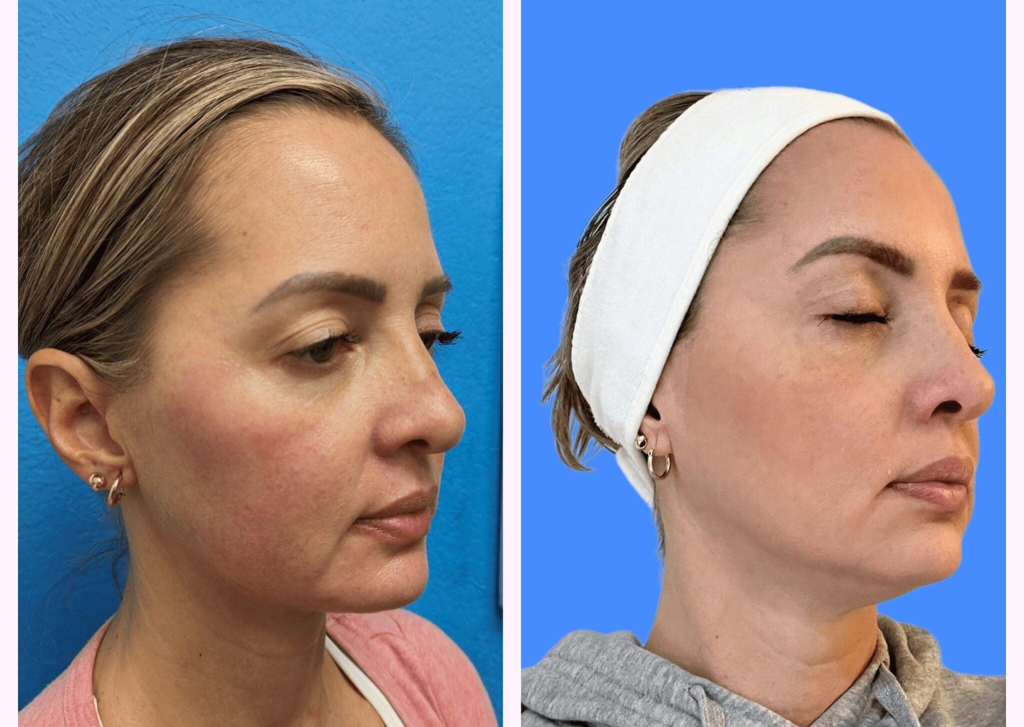 PDO Threads Face Non-Surgical Rejuvenation | Danik MedSpa PDO Threads Face Non-Surgical Rejuvenation | Danik MedSpa